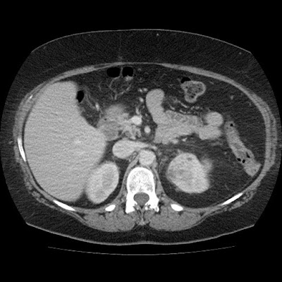 Radiology Cases: Multifocal Acute Pyelonephritis