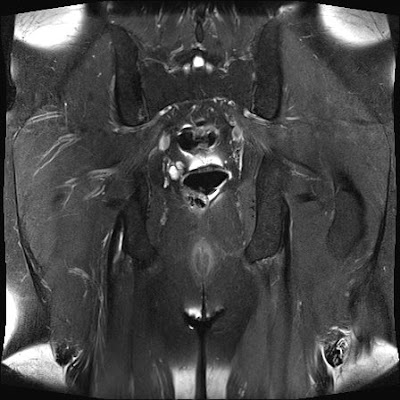 Radiology Cases: Hamstring Tendinopathy and PT tear, Osteitis Pubis and ...