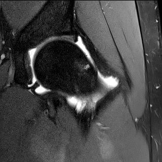 Radiology Cases: Femero-acetabular impingement (Cam type)