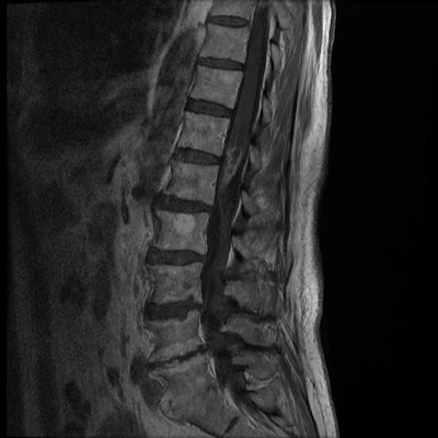 Radiology Cases: Intramedullary Abscess (involving the conus)