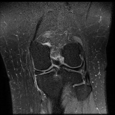 Radiology Cases: Meniscal Parrot Beak Tear