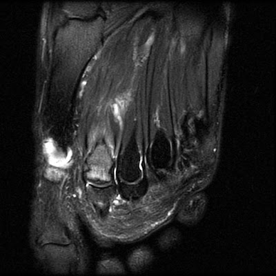 Radiology Cases: Freiberg's Disease