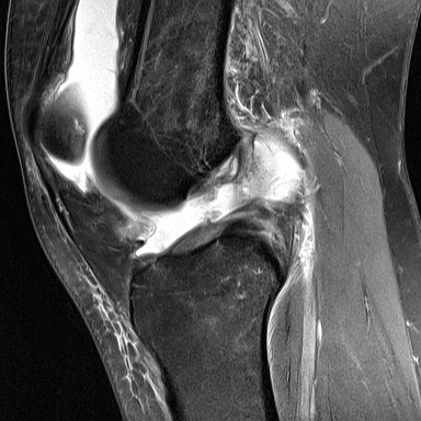 Radiology Cases: ACL Tear and Wrisberg Rip