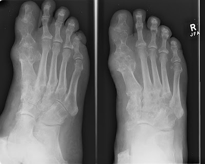 Radiology Cases: Severe Gouty Arthritis