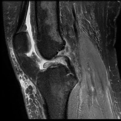 Radiology Cases: Subtle Wrisberg Rip (in setting of ACL tear)