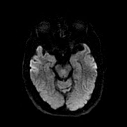 Radiology Cases: Decussation Of Superior Cerebellar Peduncle Fibres