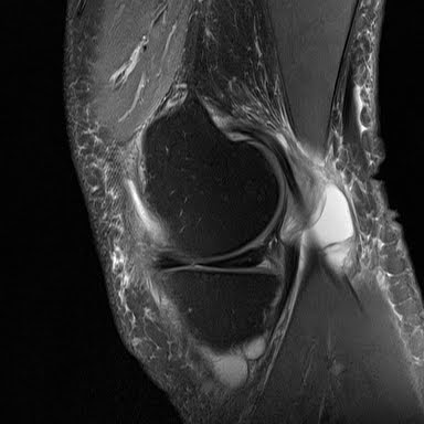 Radiology Cases: Meniscal Flounce