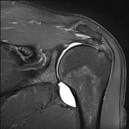 Radiology Cases: Lateral Downsloping of Acromion