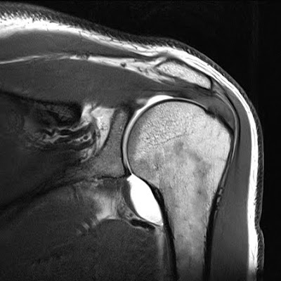 Radiology Cases: Lateral Downsloping of Acromion