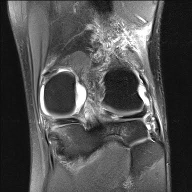 Radiology Cases: Vertical Tear LM