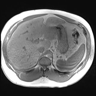 Radiology Cases: Fatty Liver