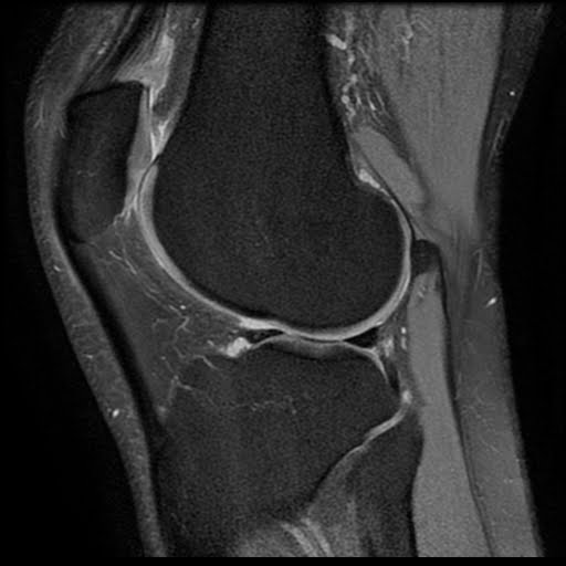 Radiology Cases: Quadriceps/Anterior Suprapatella Impingement Syndrome