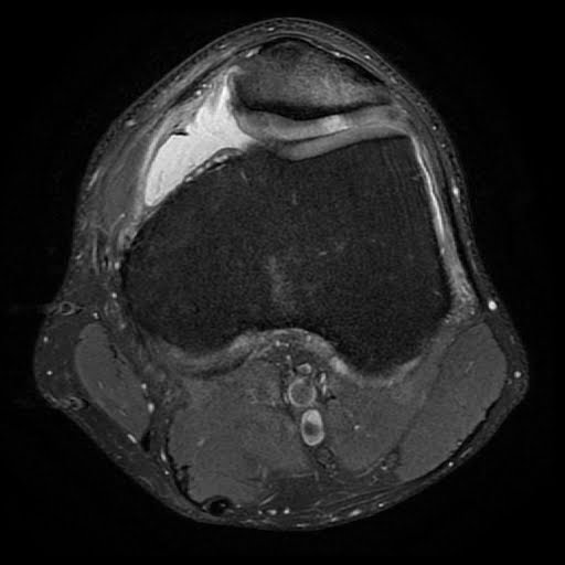 Radiology Cases: Acute Patella Chondral Contusion