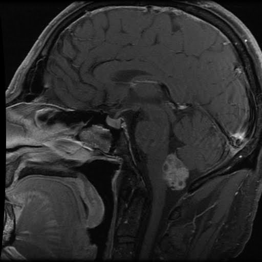 Radiology Cases: Subependymoma