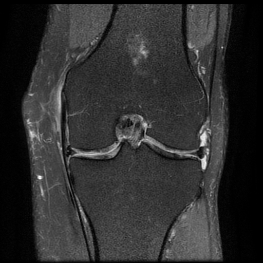 Radiology Cases: Chondrocalcinosis