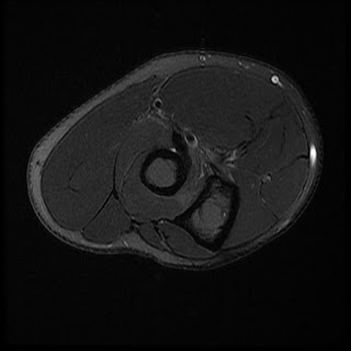 Radiology Cases: PIN Syndrome (2)