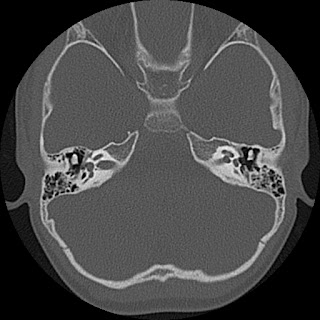 Radiology Cases: Mondini malformation