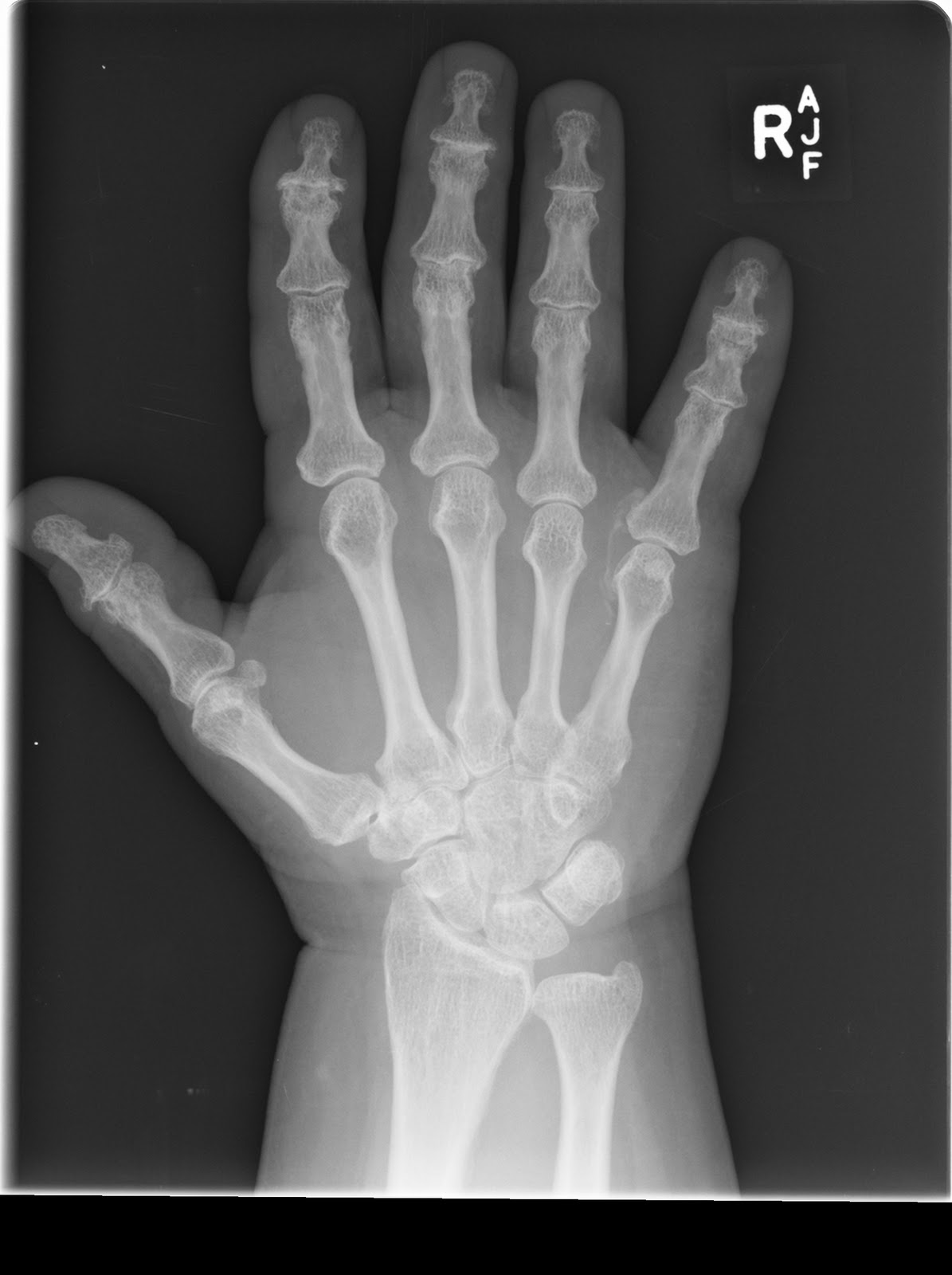 Radiology Cases: Acute Calcific Capsultis