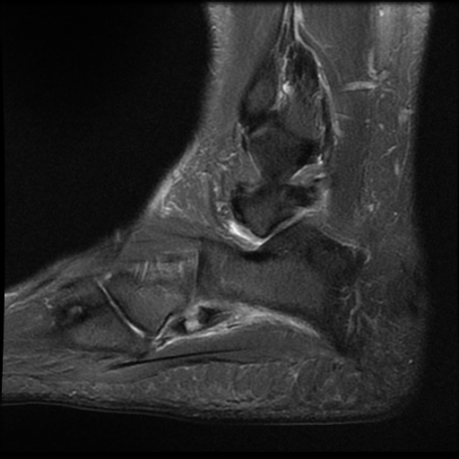 Radiology Cases: Os Peroneum Fracture