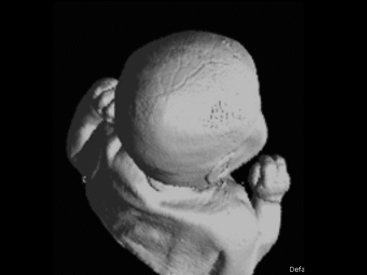 My Radiology World: "Trigonocephaly"