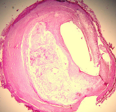 PATOLOGIA: PATOLOGÍA DE LA CIRCULACIÓN-3