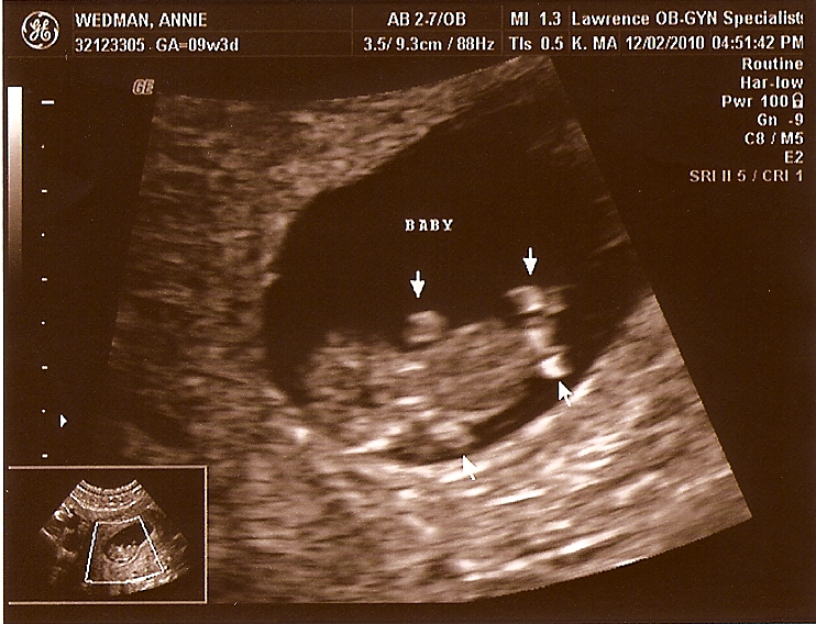 The Wedman Family: 10 Weeks Sonogram