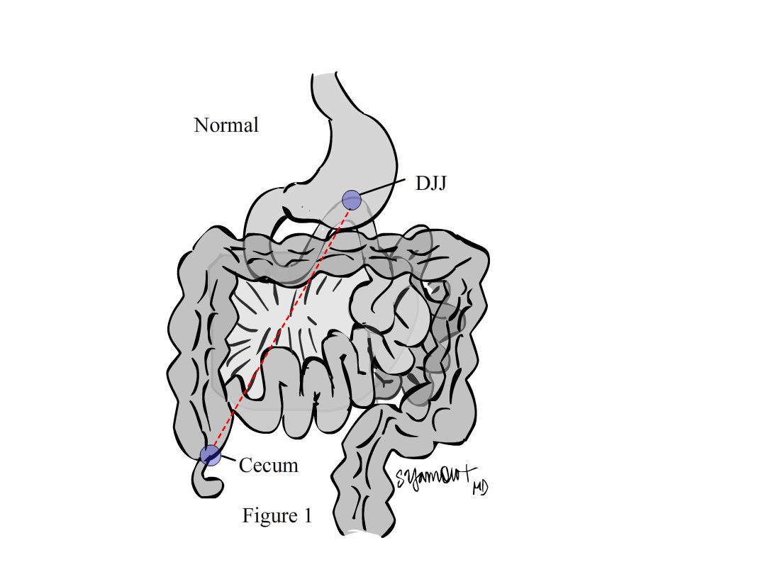 Pediatric Surgery Zone: Rotational anomalies of the midgut... what's what?