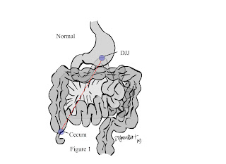 Pediatric Surgery Zone: Rotational anomalies of the midgut... what's what?