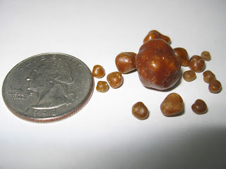 Gallbladder Stones: Colour of gallstones