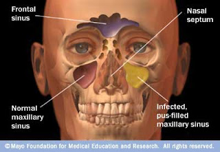 Claves de Salud: Dieta y fitoterapia para personas con sinusitis