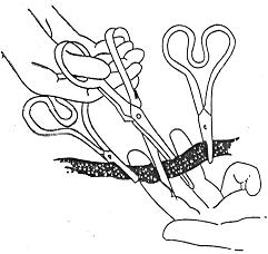 Gambar Memotong Tali Pusat