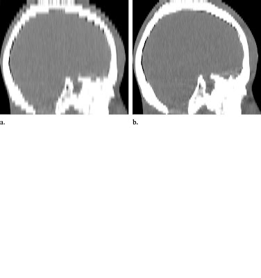 CT_physics_2009: ARTIFACTS IN SPIRAL CT