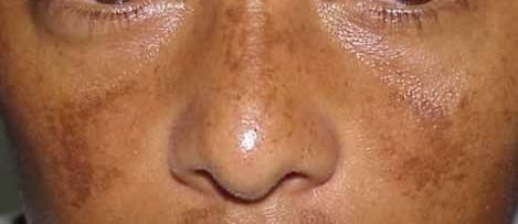 All About Skin: What Is Melasma / Chloasma.