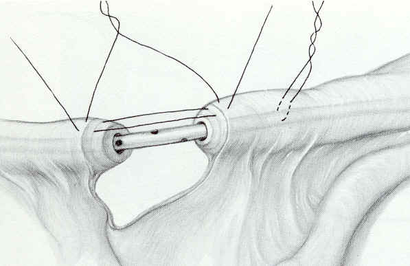 Tubal Reversal Surgery