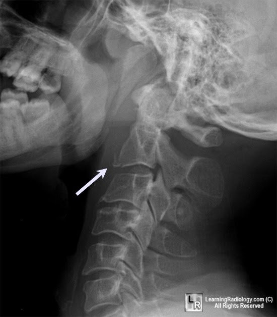 International University: extension Tear Drop Fracture