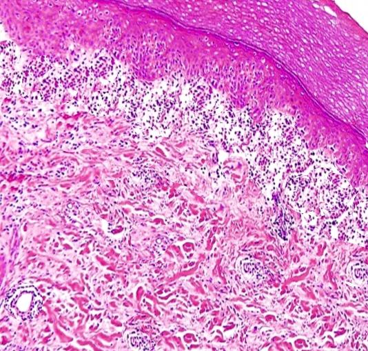 Dermatopathology Case 58