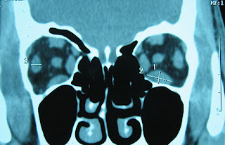 a little bit of medicine: Boala Basedow-Graves-Perry