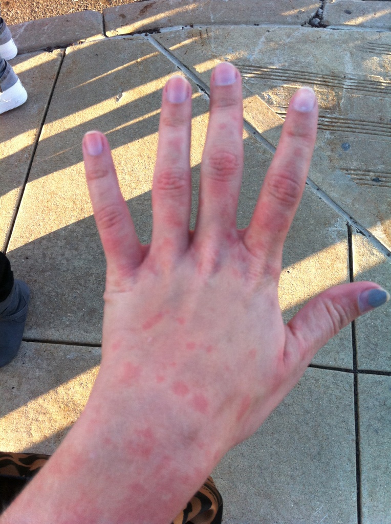 Allison's Health Blog: cold urticaria.