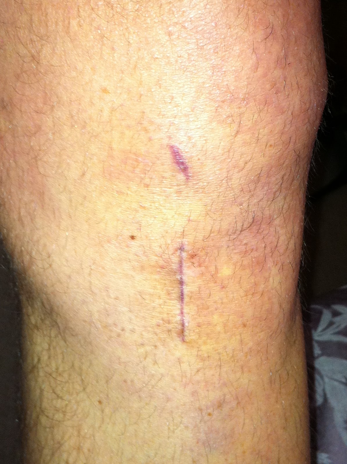 are you the running guy?: ACL Operation - 19th November 2010