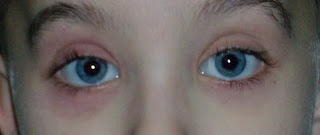 Homeschool Distractions: Allergic Shiners