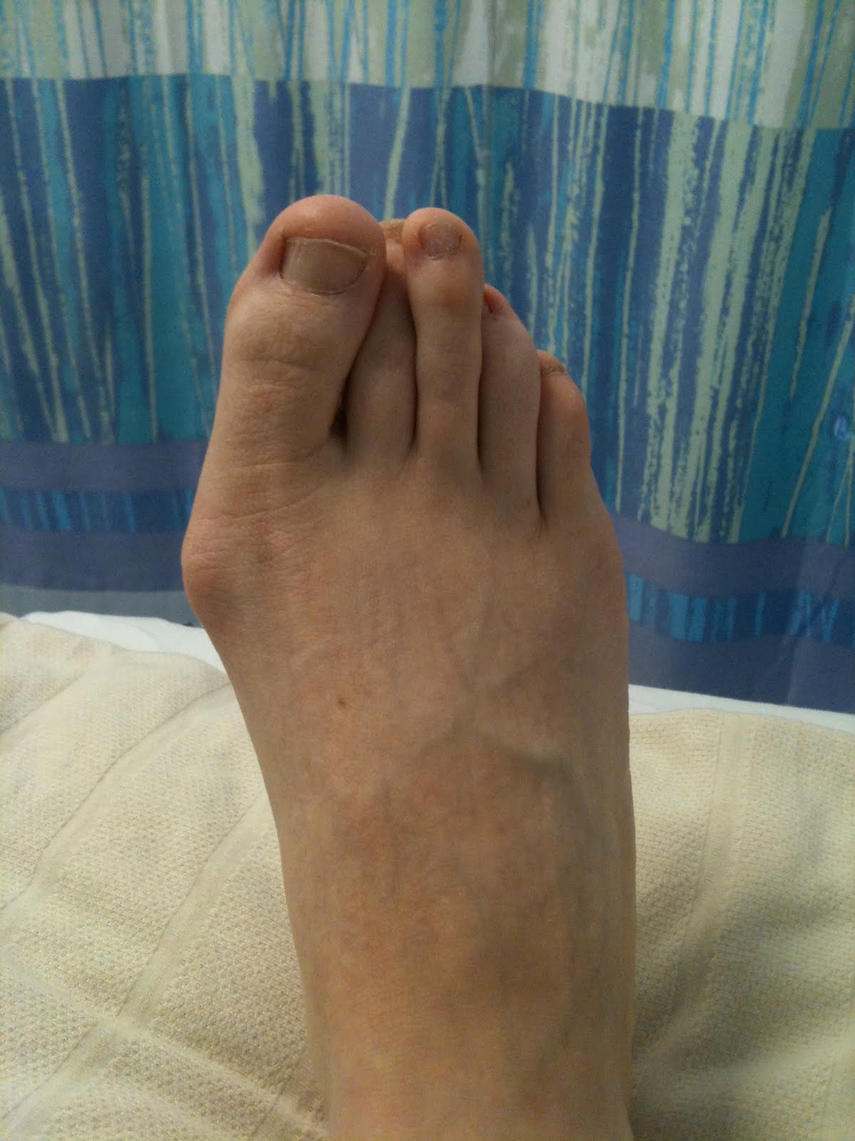 Everyday Rainbows: Post-op Bunion operation picture (look away if ...
