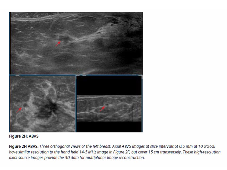 BÀI SOẠN VỀ SIÊU ÂM CHẨN ĐOÁN: SONOGRAPHIC ELASTOGRAPHY of the BREAST ...