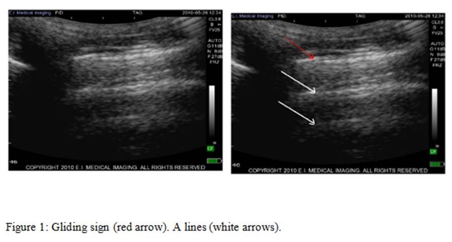 BÀI SOẠN VỀ SIÊU ÂM CHẨN ĐOÁN: A-LINES, B-LINES and AIR ARTIFACTS