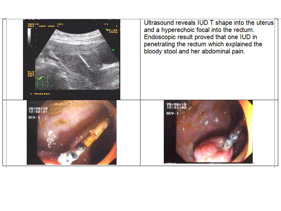 BÀI SOẠN VỀ SIÊU ÂM CHẨN ĐOÁN: INTRAABDOMINAL MIGRATING of INTRAUTERINE ...