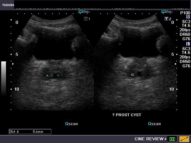cochinblogs: TRUS (transrectal ultrasound) of prostate utricle cyst: