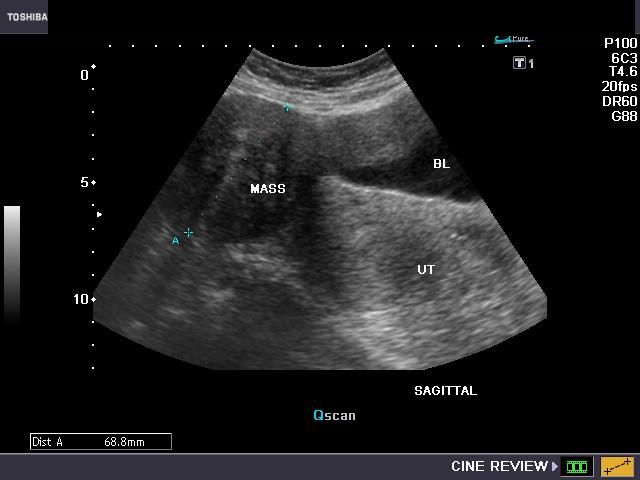 cochinblogs: Subserosal fibroid