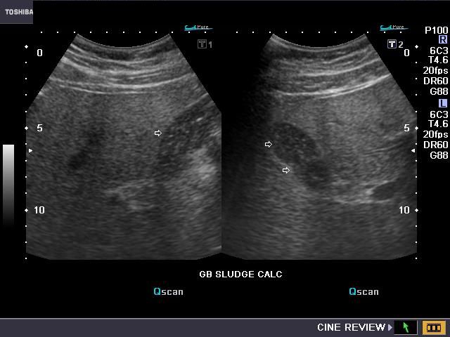 Gallbladder Ultrasound Sludge