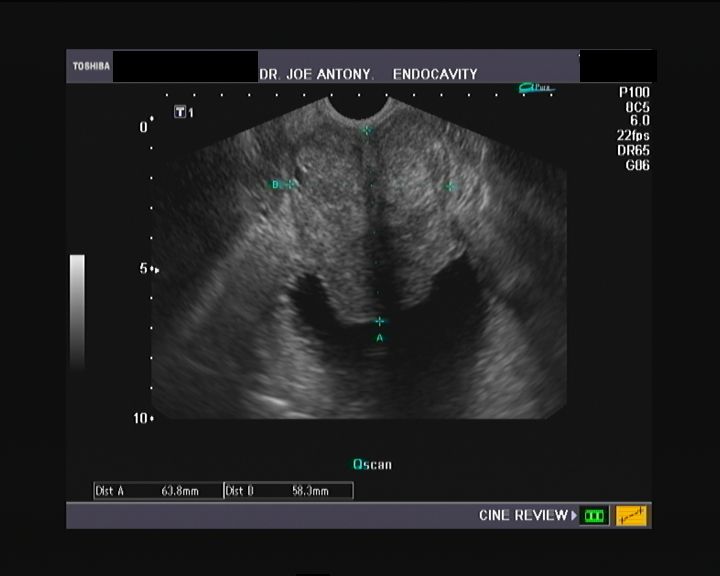 Ultrasound And Color Doppler Videos Benign Prostatic Hypertrophy Trus Ultrasound Videos