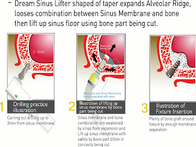 IBS Implant: Innovative IBS Implant System