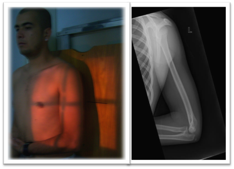 Guía multimedia en procesos de radiología: RADIOGRAFIA DE BRAZO EN ...